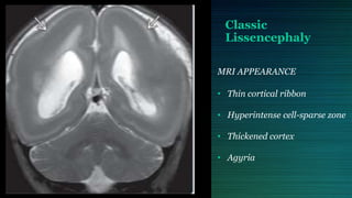 Septo Optic Dysplasia Ribbon