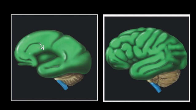 congenital brain anomalies | PPTX | Brain and Nervous System Disorders ...