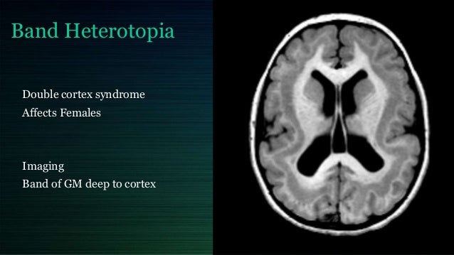 congenital brain anomalies
