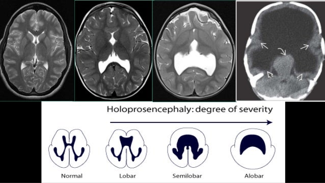 congenital brain anomalies