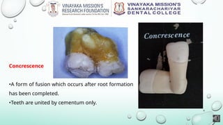 Developmental disturbances of shape of teeth.pptx