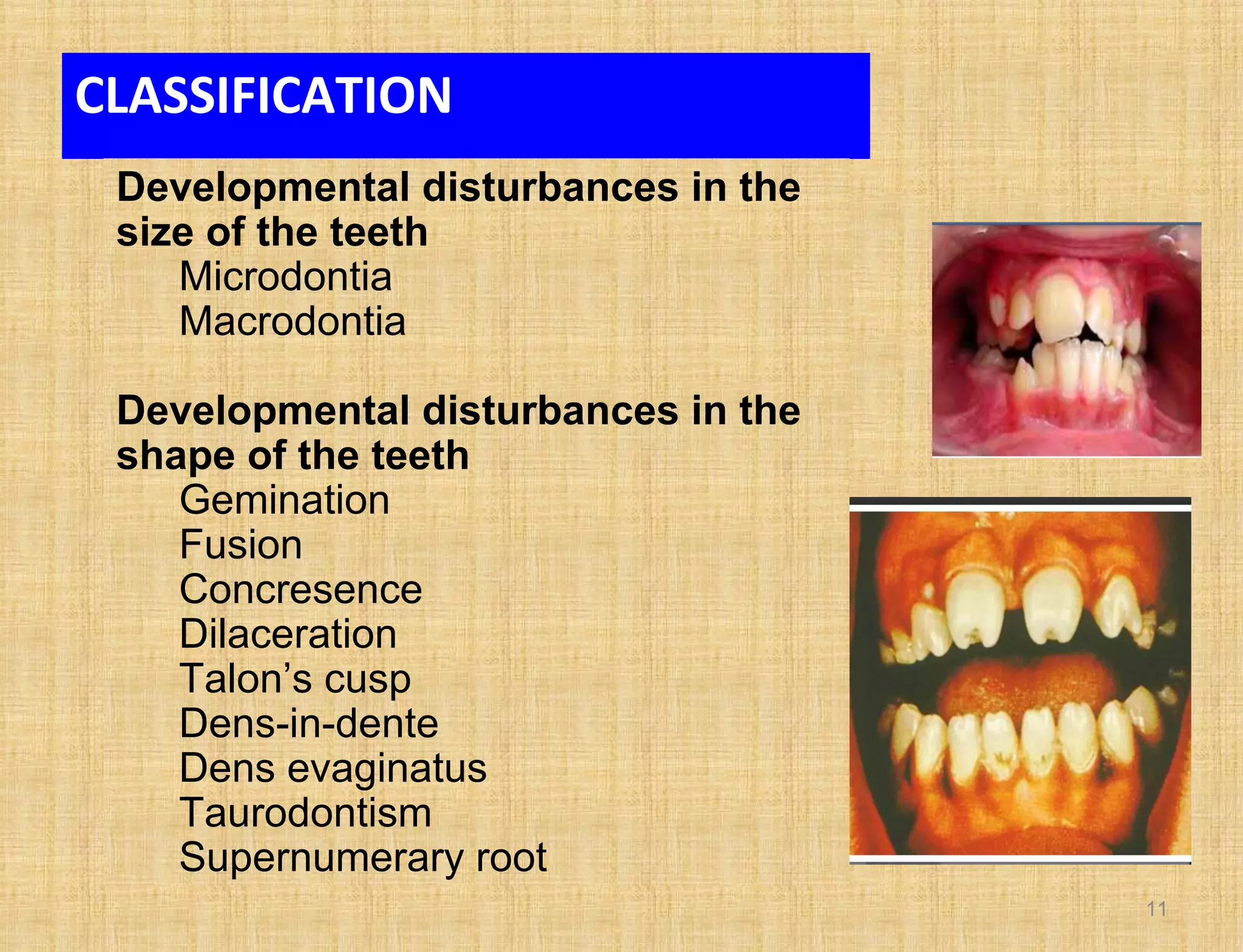Developmental disturbances ofteeth sem | PPT