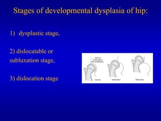 Develompmental_dysplasia_of_the_hip_2022 | PPT