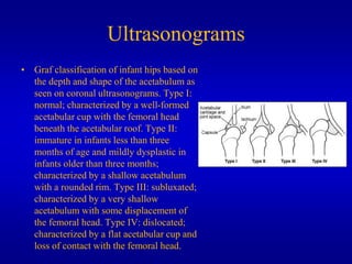 Develompmental_dysplasia_of_the_hip_2022 | PPT