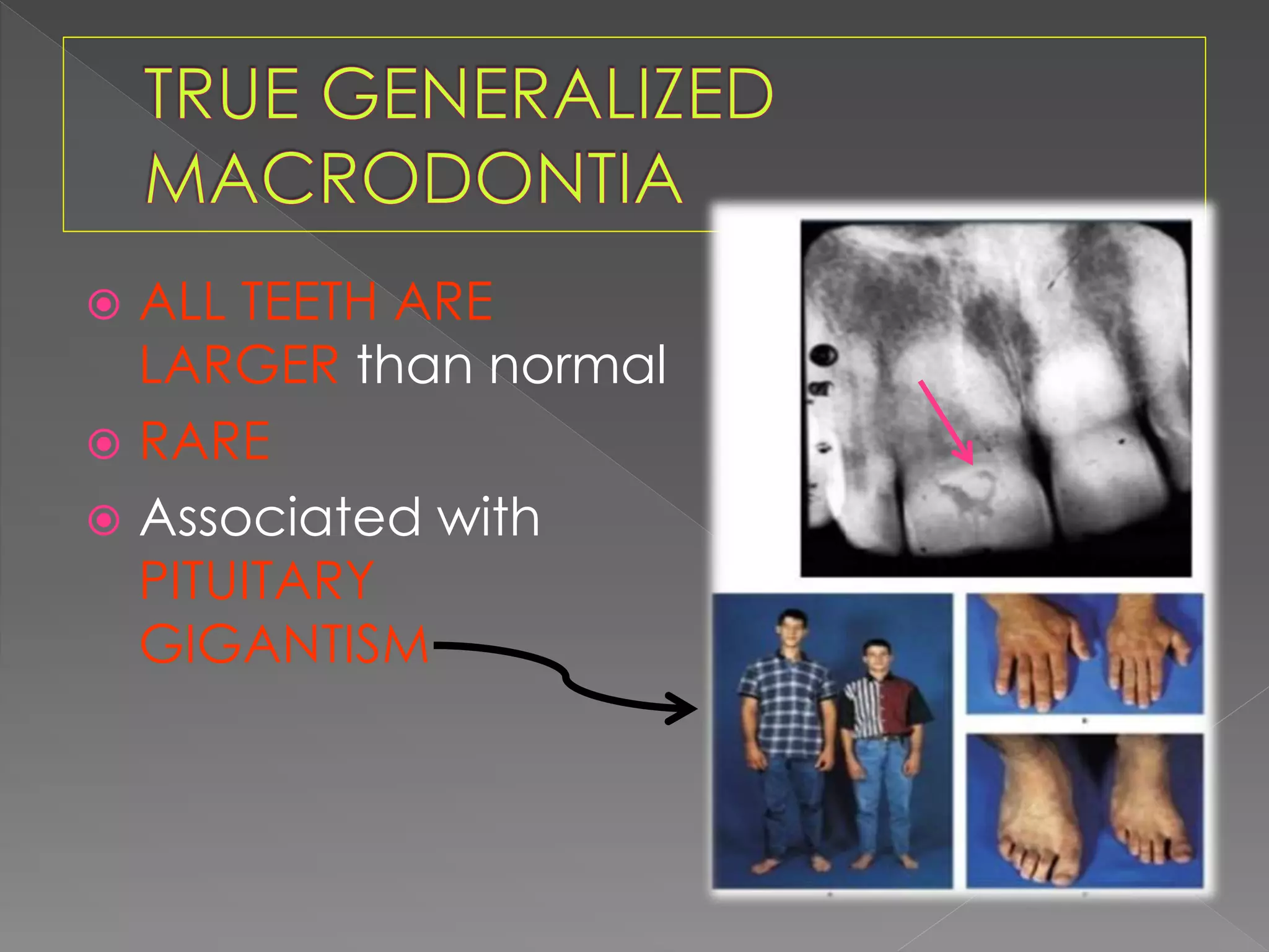 Developmental anomalies of teeth - by variyta | PPTX
