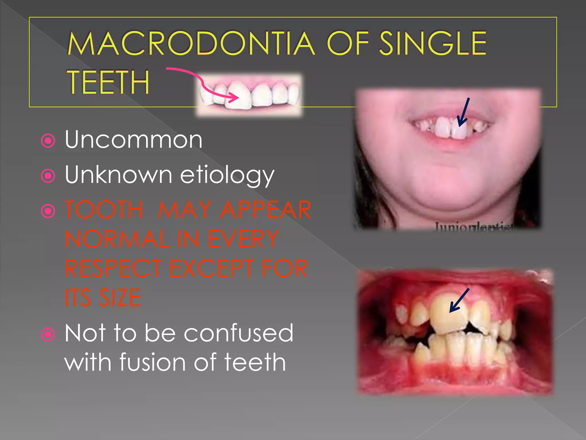 Developmental anomalies of teeth - by variyta | PPTX
