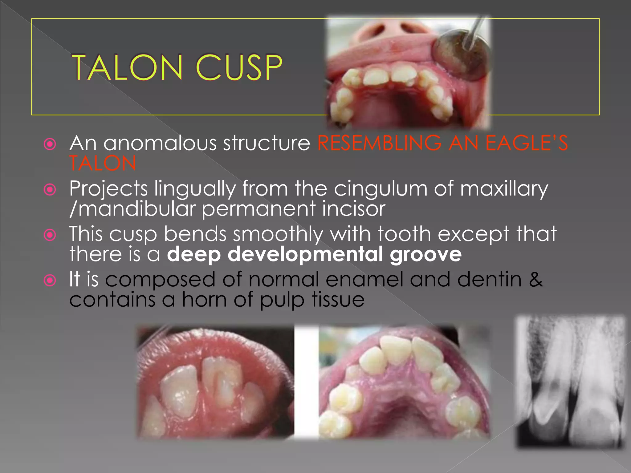 Developmental anomalies of teeth - by variyta | PPT