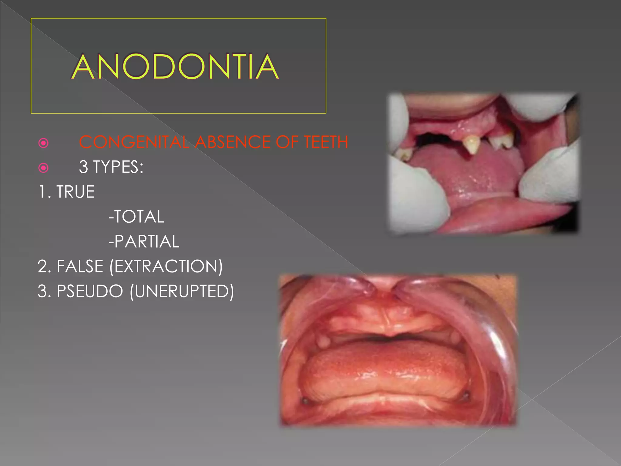 Developmental anomalies of teeth - by variyta | PPTX