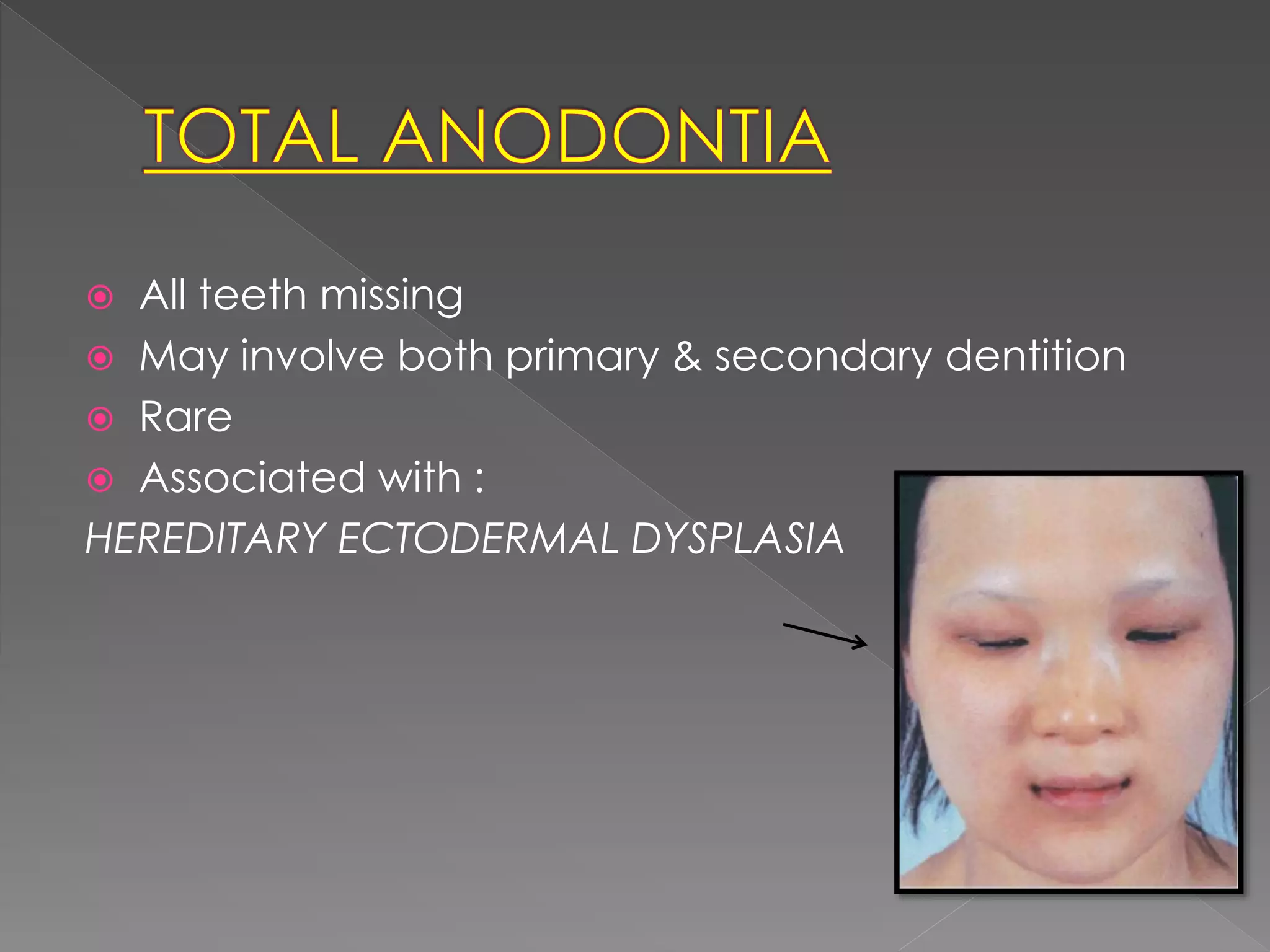 Developmental anomalies of teeth - by variyta | PPTX