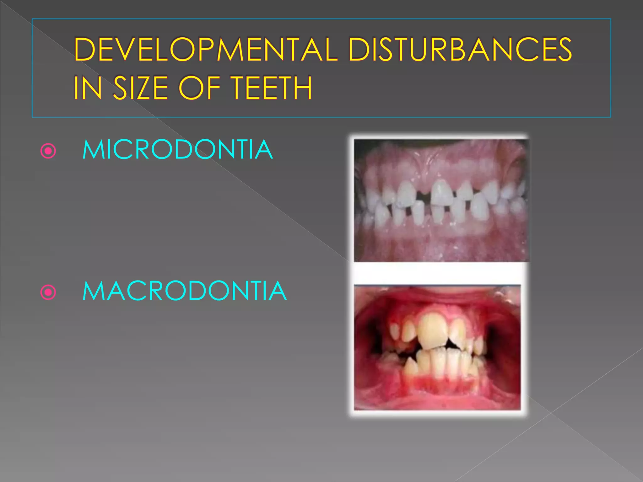 Developmental anomalies of teeth - by variyta | PPTX