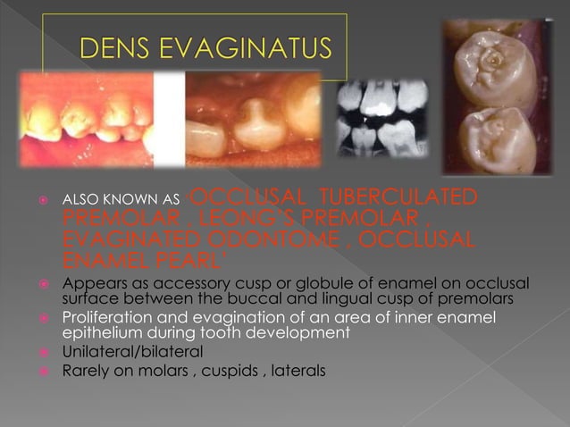 Developmental anomalies of teeth - by variyta | PPTX | Dental Health ...