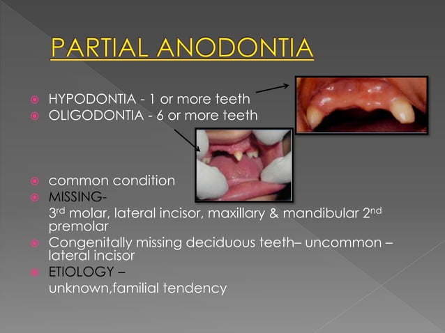 Developmental anomalies of teeth - by variyta | PPTX | Dental Health ...