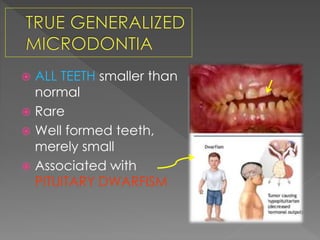 True Generalized Microdontia