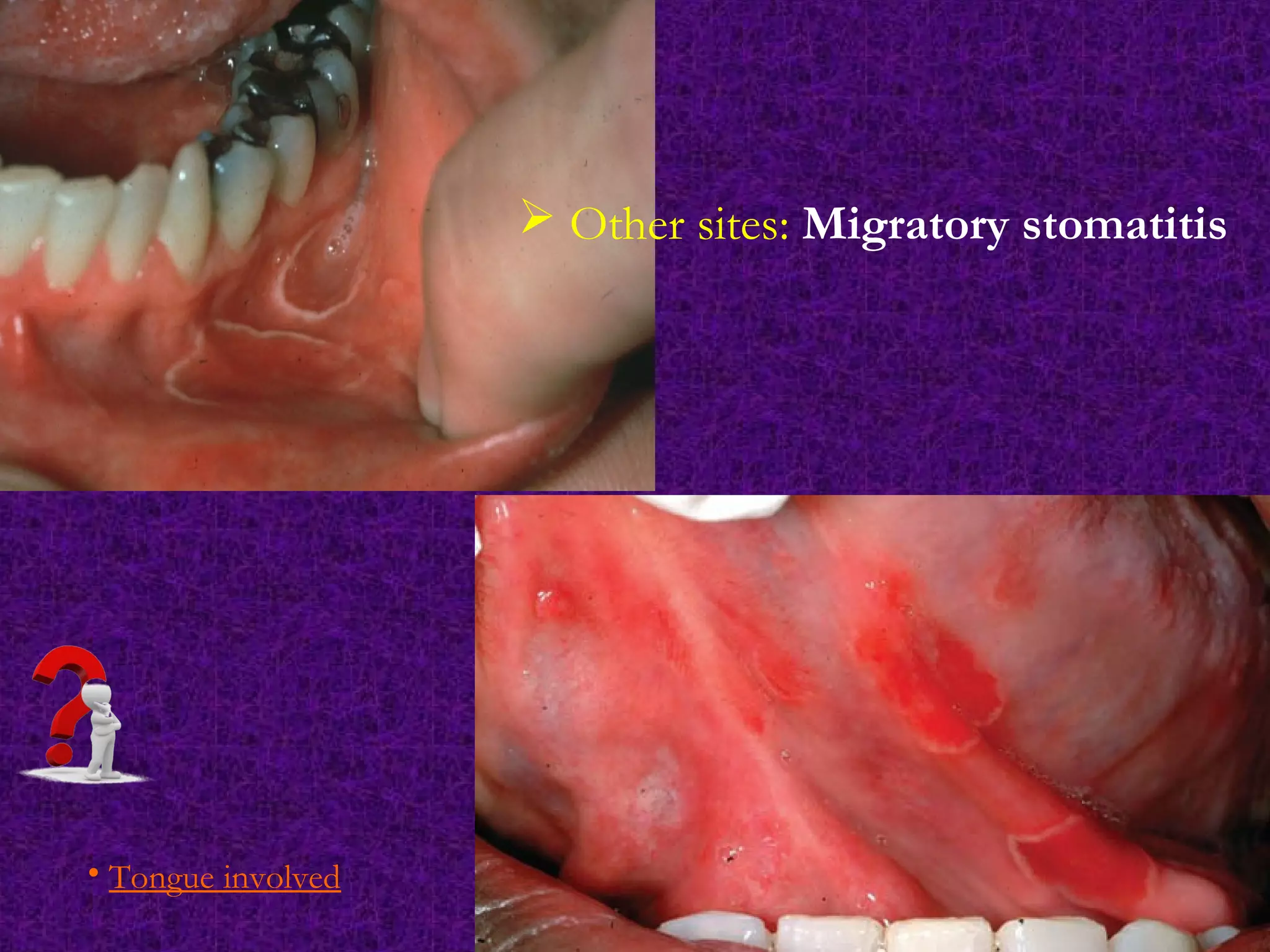 Oral Developmental anomalies | PPT