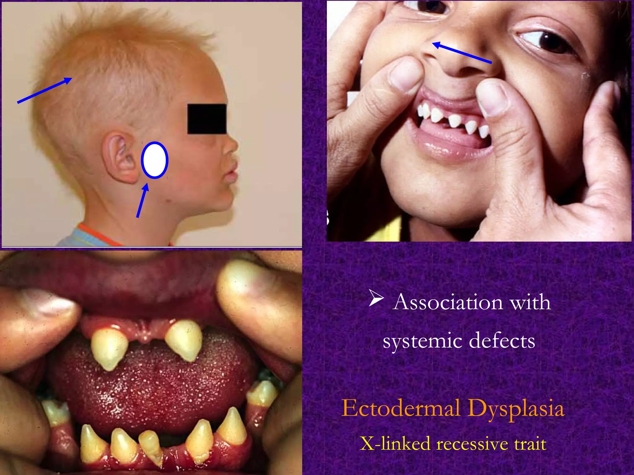 Oral Developmental anomalies | PPT
