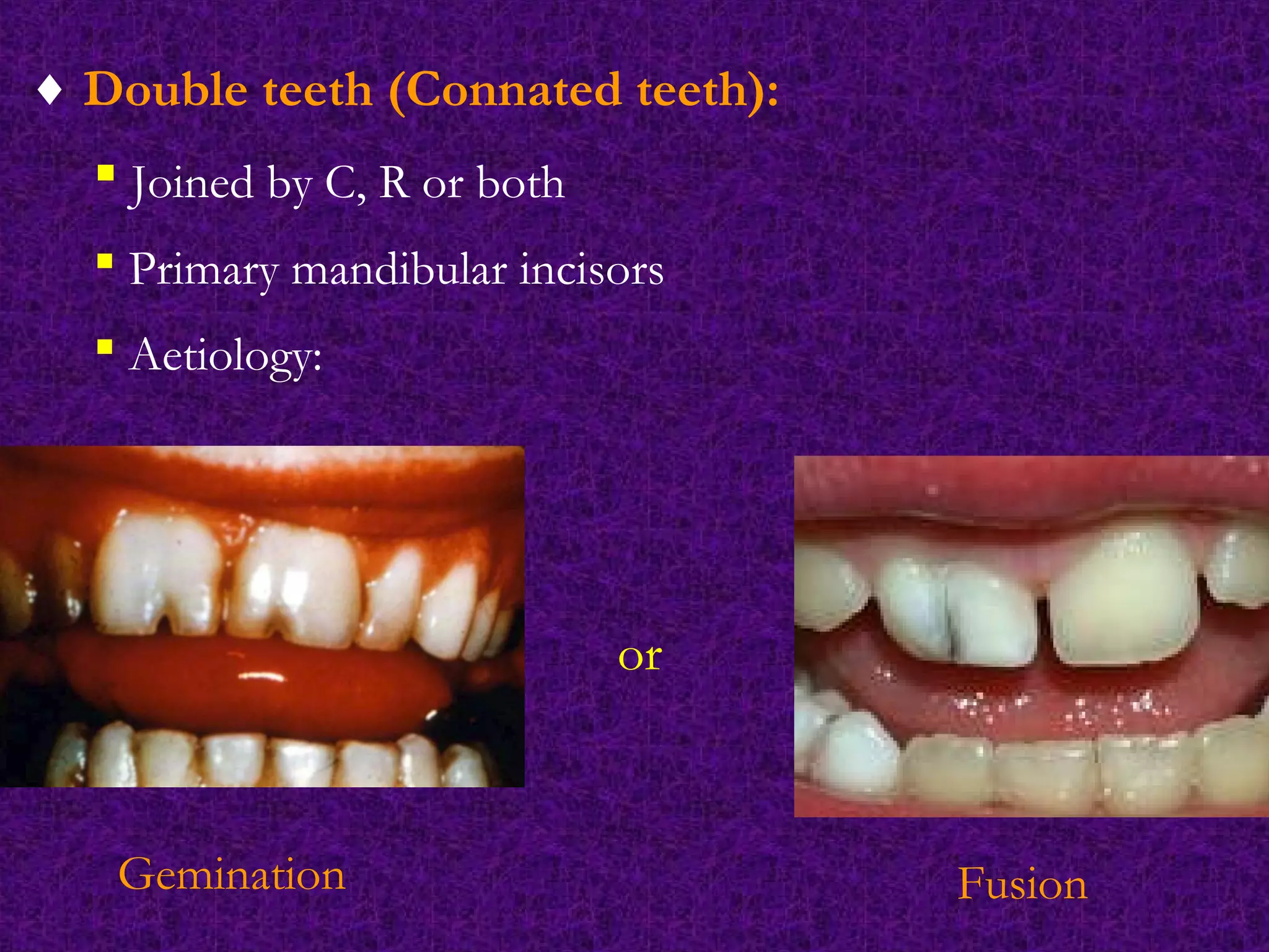 Oral Developmental anomalies | PPT