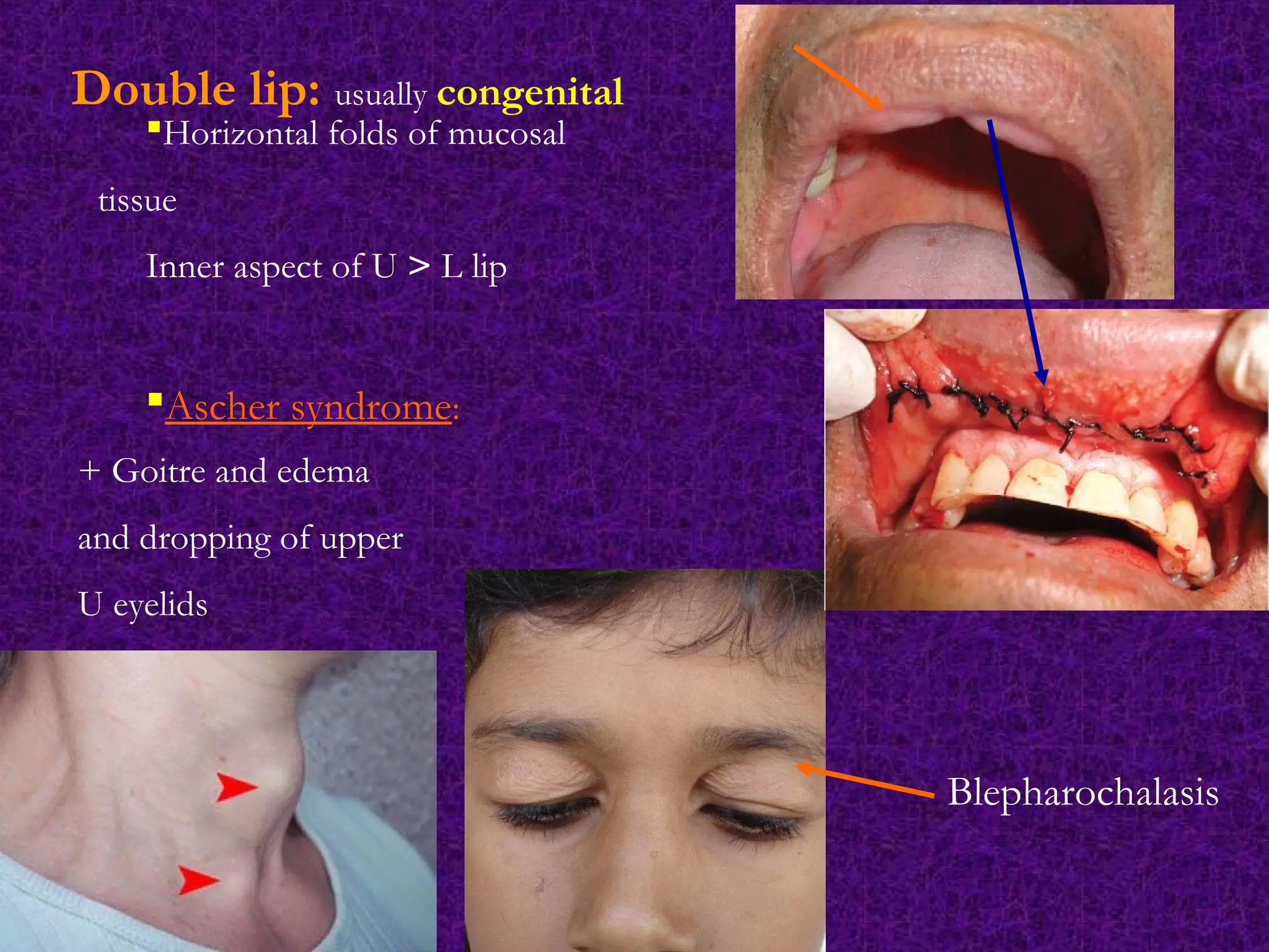 Oral Developmental anomalies | PPT