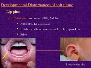 Oral Developmental anomalies | PPT