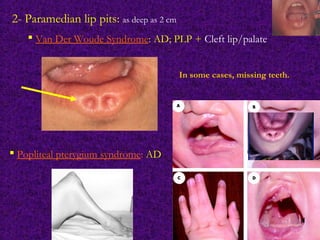 Oral Developmental anomalies | PPT