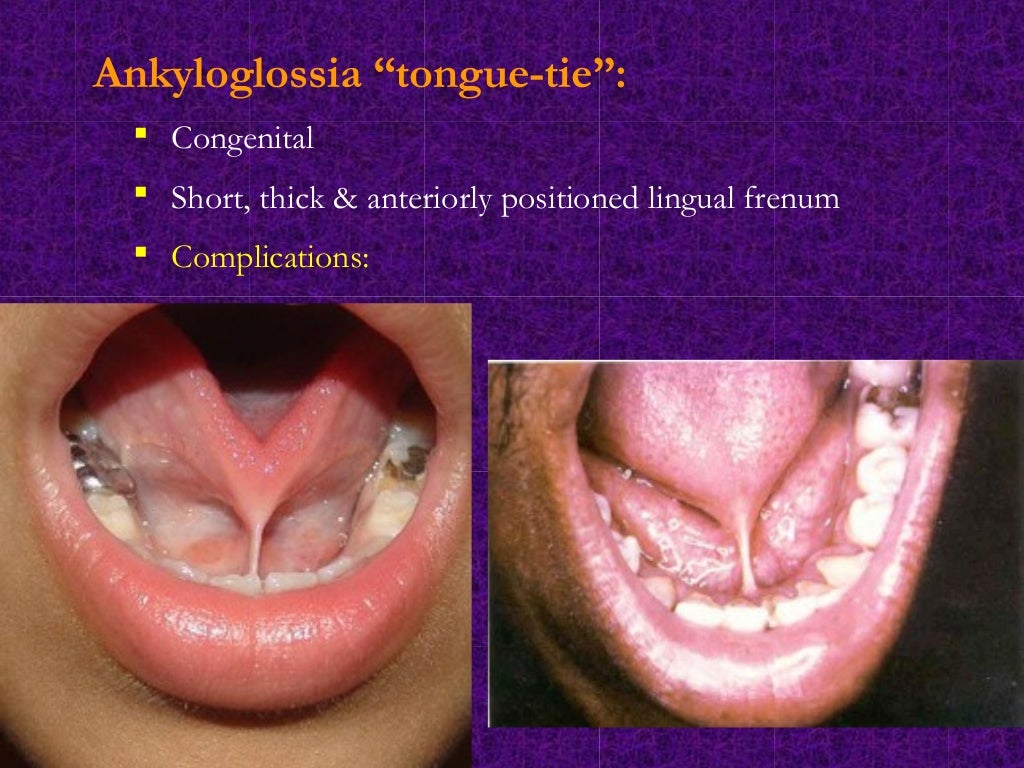 Oral Developmental anomalies