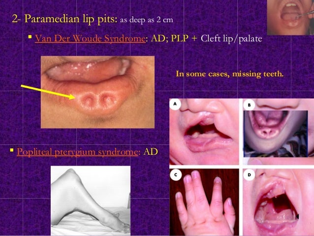 Oral Developmental anomalies