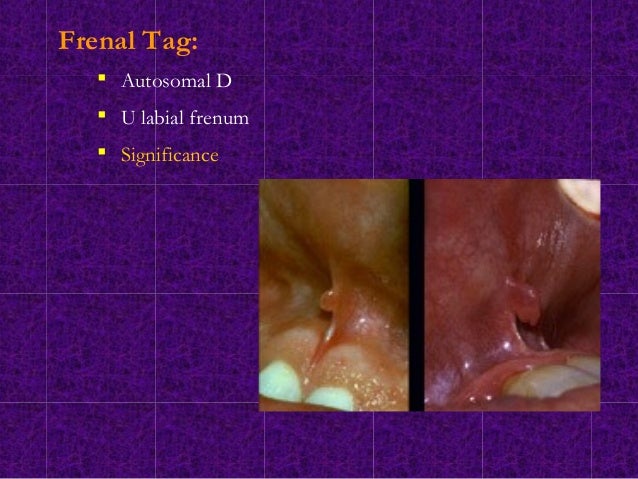 Oral Developmental anomalies