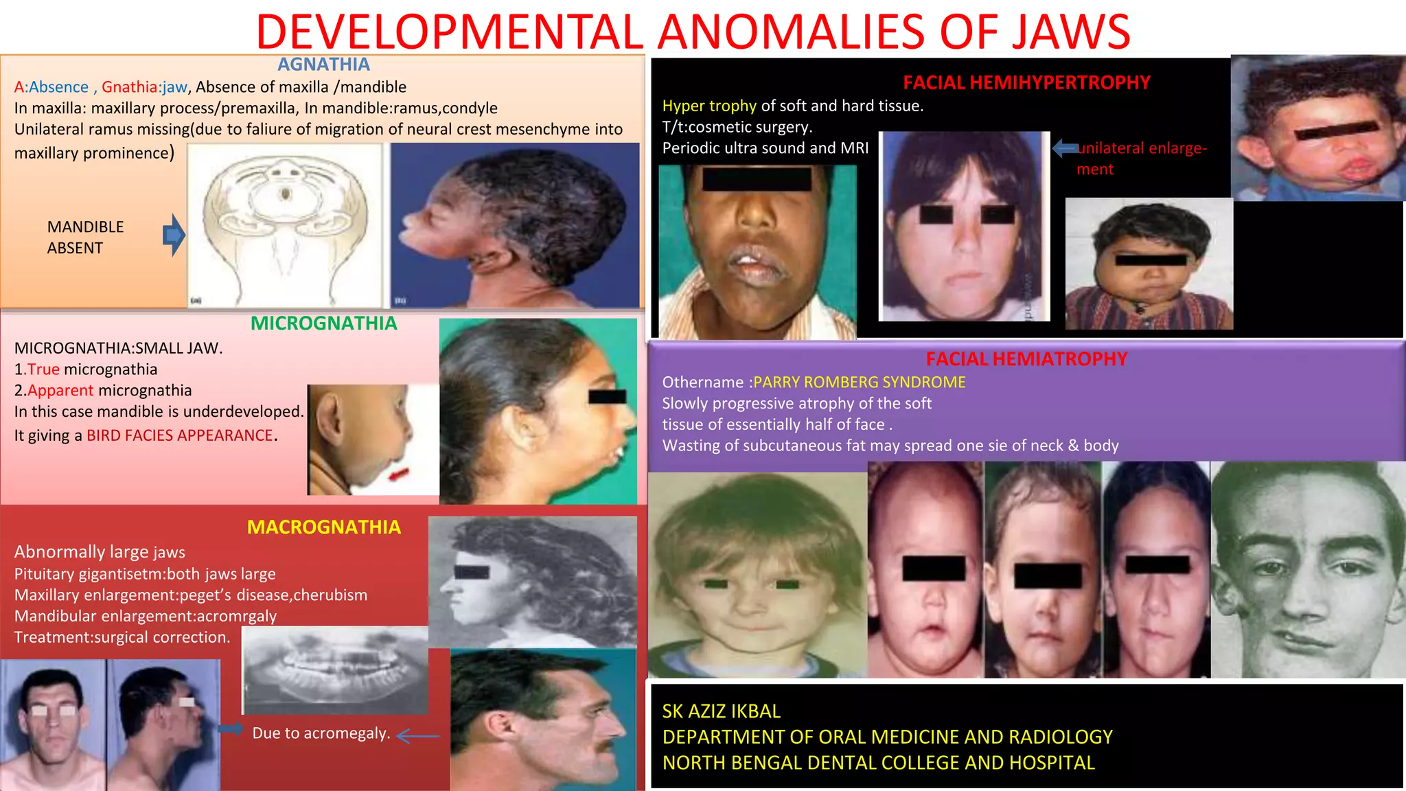 Developmental anomalies of jaws | PPTX