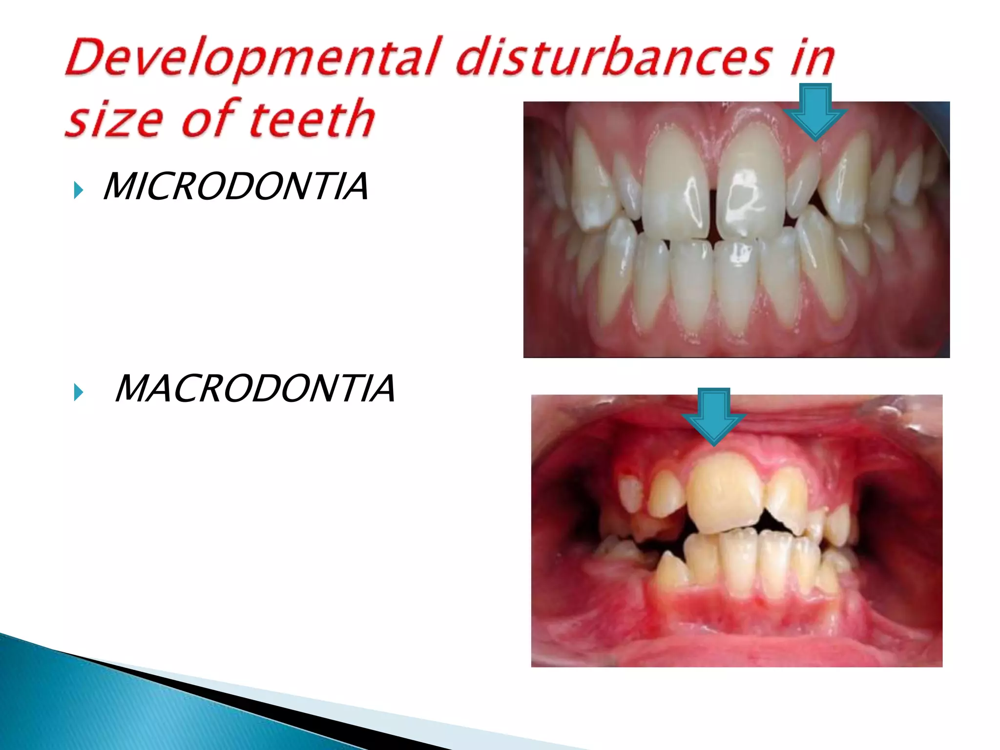 Developmental anomalies of teeth ,, | PPTX