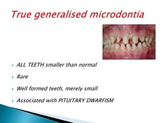 True Generalized Microdontia