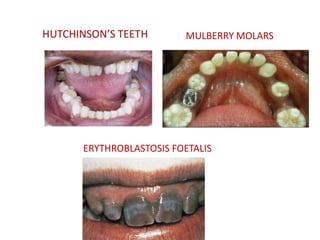 Hutchinson Teeth Mulberry Molars