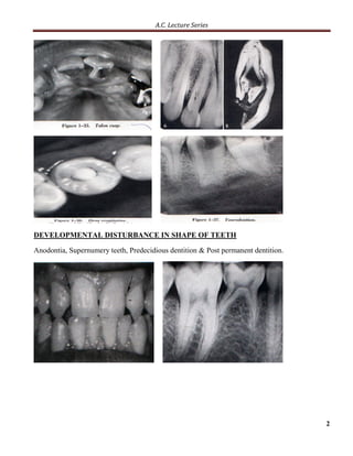 Developmental anomalies of the tooth | PDF