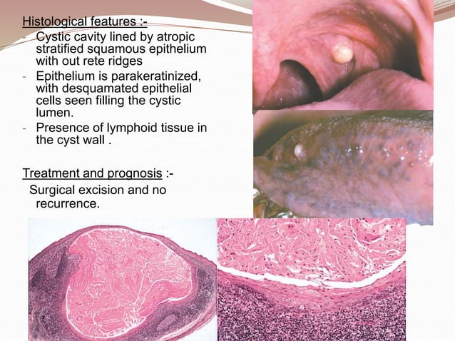 Developmental cysts.pptx | Ear, Nose and Throat Conditions | Diseases ...