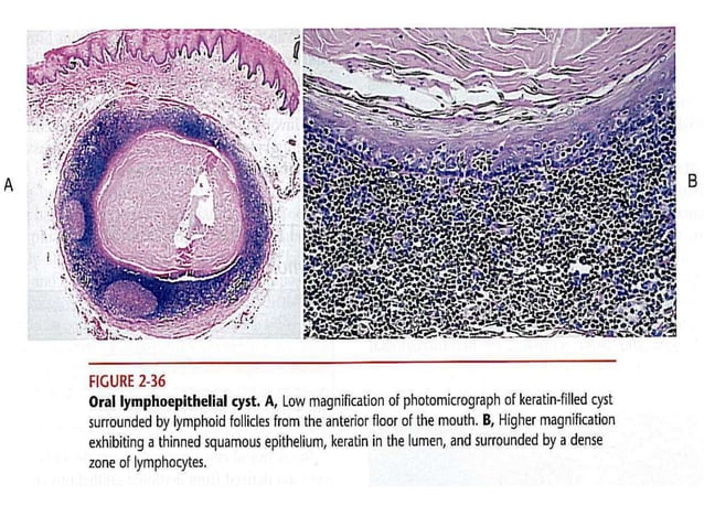 Developmental cysts and syndroms | PPT
