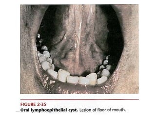 Lymphoepithelial Cysts