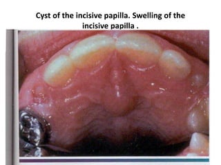 Incisive Papilla Inflammation