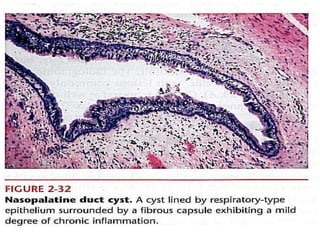 Nasopalatine Duct Cyst Histology