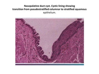 Nasopalatine Cyst Histology