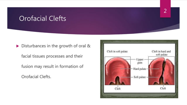 Developmental defects of oral & maxillofacial region | PPTX | Dental ...