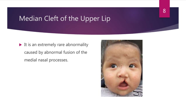 Developmental defects of oral & maxillofacial region | PPTX | Dental ...