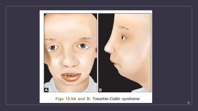 Developmental Defects Of Orofacial Structures | PPTX