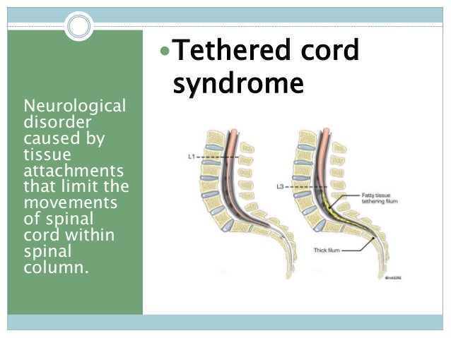 Developmental disease of spinal cord