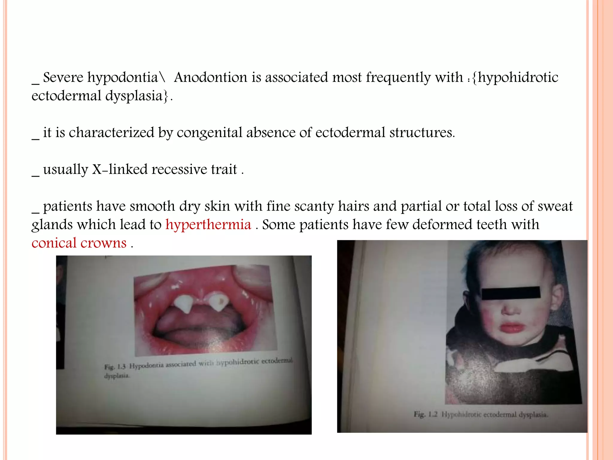 Oral Pathology - Developmental disorders of teeth and craniofacial ...
