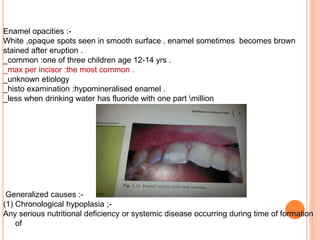 Oral Pathology - Developmental disorders of teeth and craniofacial ...