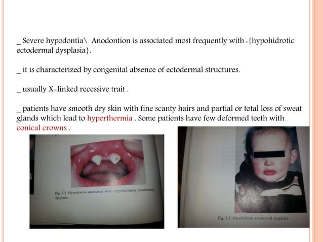 Oral Pathology - Developmental disorders of teeth and craniofacial ...