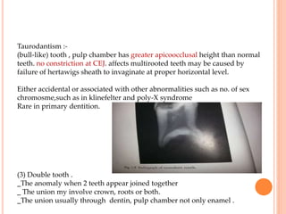 Oral Pathology - Developmental disorders of teeth and craniofacial ...