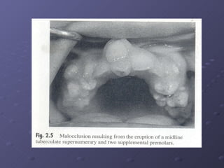 Developmental disorders of teeth and related tissue | PPT