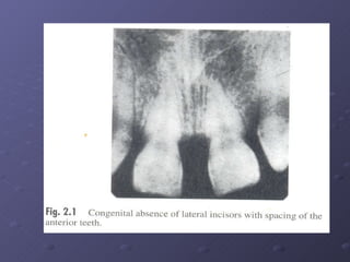 Developmental disorders of teeth and related tissue | PPT