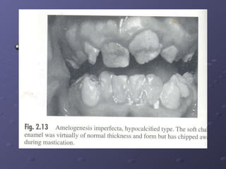 Developmental disorders of teeth and related tissue | PPT