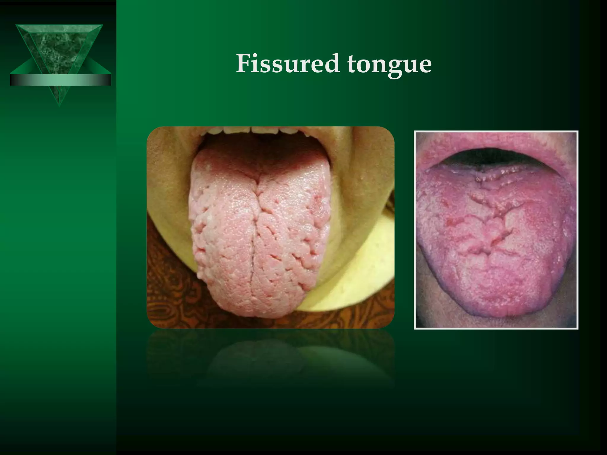 Developmental disorders of tongue elvis chiramel david | PPTX