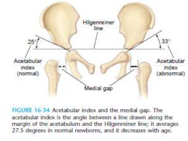 Developmental displasia of hip